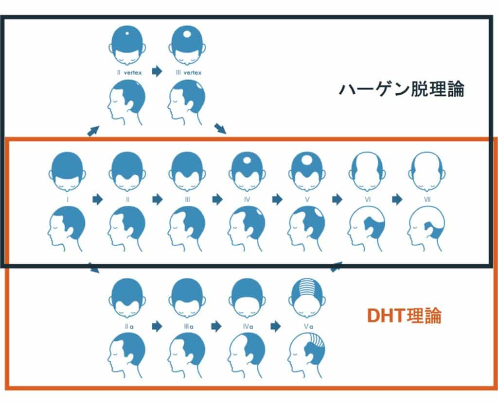 AGAのタイプ別分類と発症パターン｜AGAを巻き戻せ！