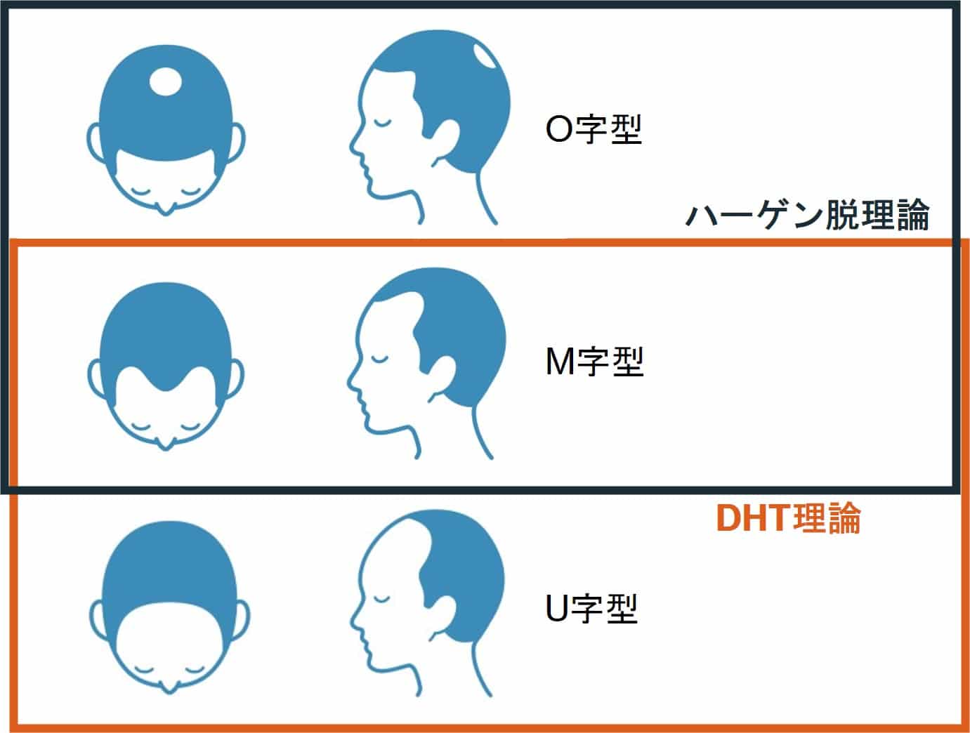 AGAのタイプ別分類と発症パターン｜AGAを巻き戻せ！